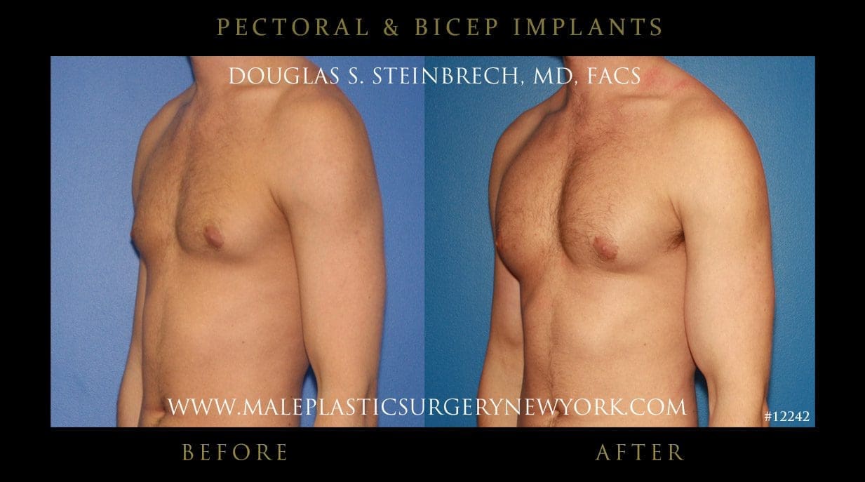 Bicep Implants For Men - Male Plastic Surgery New York